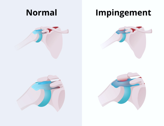 Understanding common shoulder disorders and injuries | SJMC Understanding common shoulder disorders and injuries | SJMC